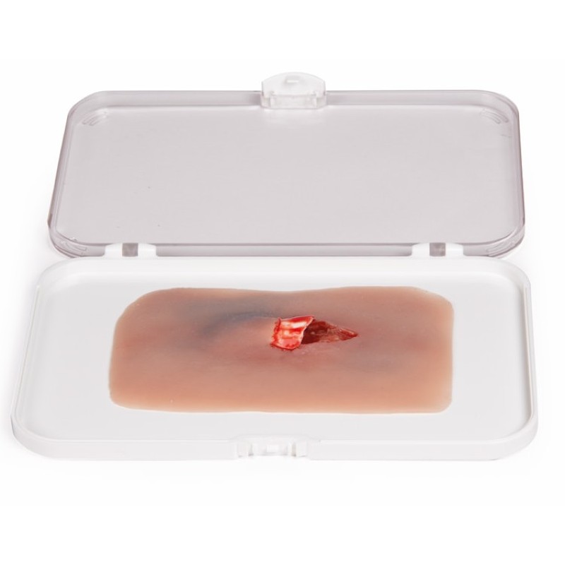 Erler-Zimmer Moulage Open Fracture - MedicalSupplies.co.uk